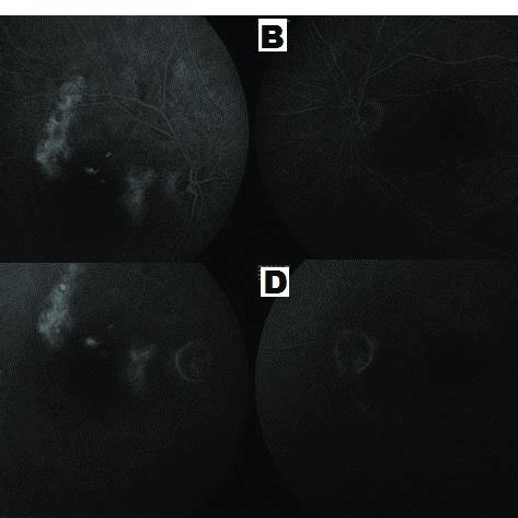 Early And Late Phaseflorescein Angiographic Frames Of Right And Left