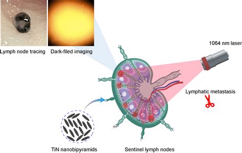 Tracing Sentinel Lymph Nodes And Inhibiting Lymphatic Metastasis With Ijn
