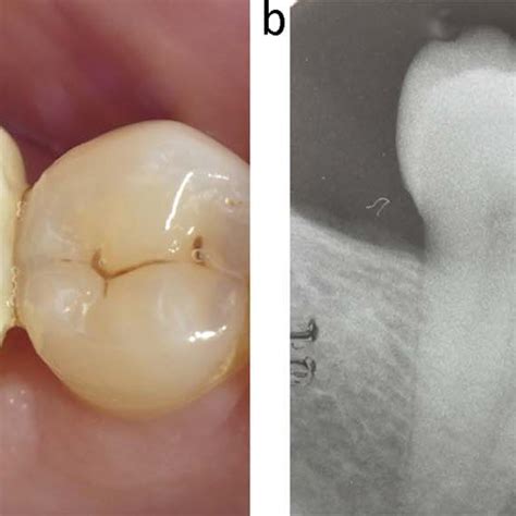 Pdf Cervical Margin Relocation In Indirect Adhesive Restorations A Literature Review