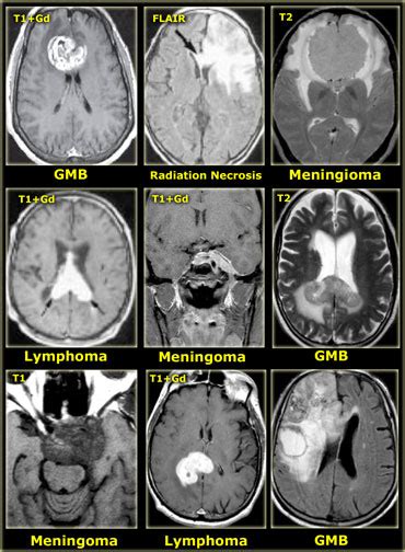 Brain Mri Scan Tumor