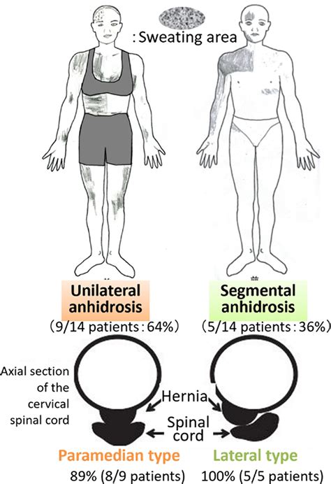 Cervical Disc Herniation Or Cervical Spondylosis May Cause Unilateral