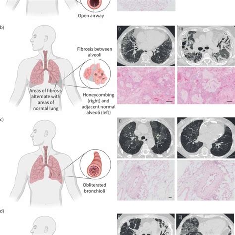 Study Cohort Abbreviations Ipf Idiopathic Pulmonary Fibrosis Ild