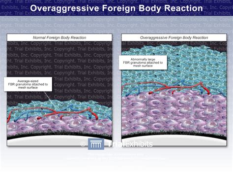 Overaggressive Foreign Body Reaction FBR Trial Exhibits Inc