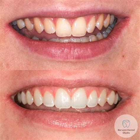 Deep Bite Crooked Upper And Lower Teeth Tooth Size Asymmetry Narrow