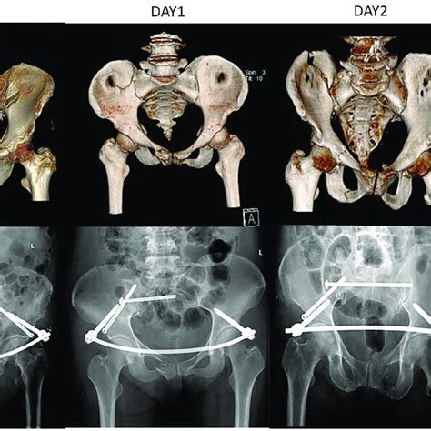 Pelvic Reduction Frame Cooperation With The C Arm And The Navigation Robot Download Scientific