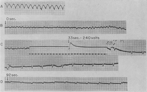 Termination Of Ventricular Fibrillation In Man By Externally Applied Electric Countershock New