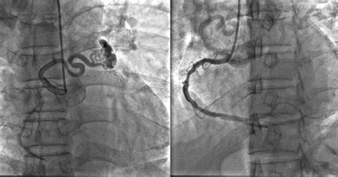 Av Fistula For Dialysis Barstow Community Hospital