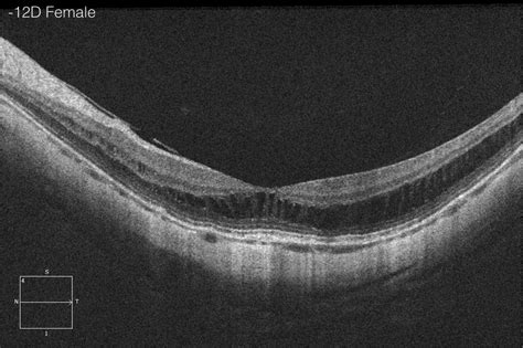 High Myopia Plus Macular Schisis
