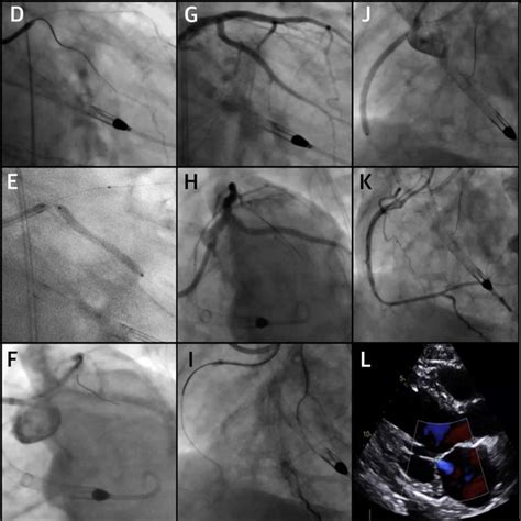 Original Coronary Angiogram Echocardiogram Pre Procedure And At Download Scientific Diagram