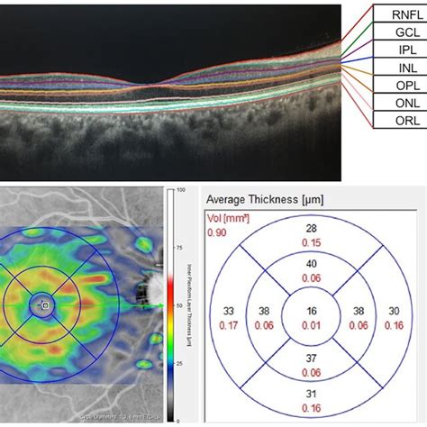 Top Retinal Layer Segmentation As Provided By Spectralis Oct 2 And Download Scientific Diagram