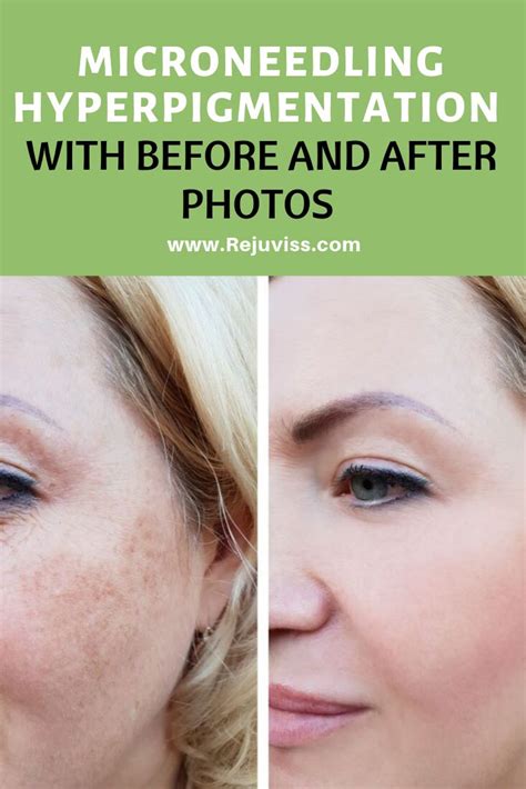 Microneedling Hyperpigmentation With Before And After Photos