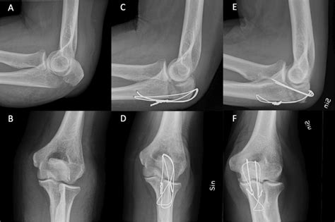 Fluoroscopy Views Of Olecranon Fractures A B Radiographs Of Olecranon Download Scientific