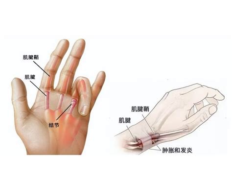 提醒！手指使不上劲还疼！当心腱鞘炎！ 知乎