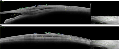 Novel Bleb Classification Following Ab Interno Implantation Journal Of Glaucoma