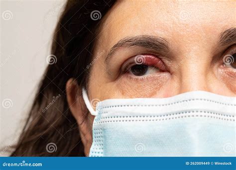 Man With Stye On Eyelid Royalty Free Stock Image