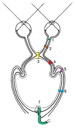 Visual Field Defects Flashcards Quizlet