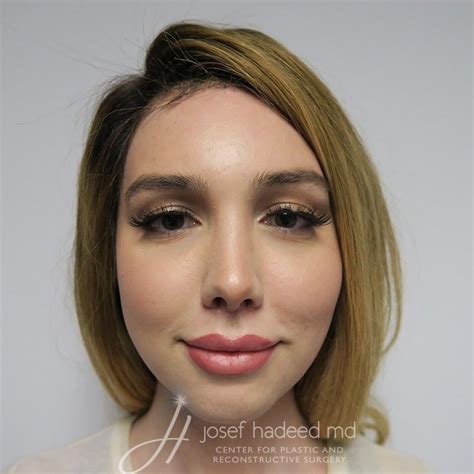 Facial Feminization Before And After Josef Hadeed Plastic Surgery