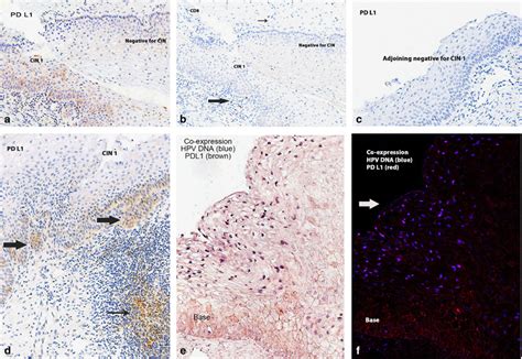 Enhanced Expression Of Pd L1 In Cervical Intraepithelial Neoplasia And