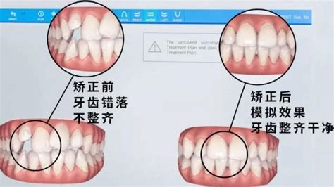 做牙齿矫正是方案重要还是医生重要？ 知乎