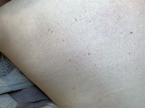 Seborrhoeic Keratosis Treatments Wimbledon And Kensington