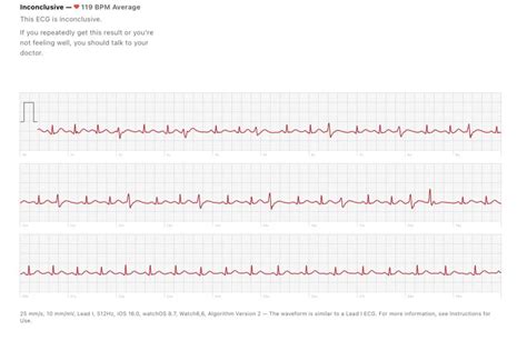 Pvcs Most Frequent During Weight Lifting Rpvcs