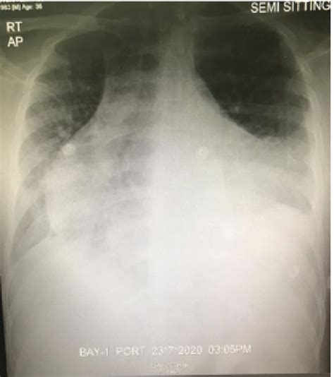 Case 3 Chest X Ray With Signs Of Pericardial Effusion Tamponade And