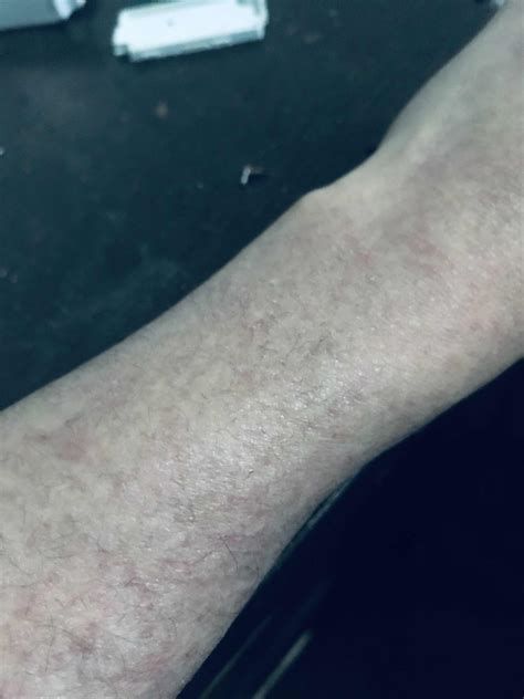 عندي صدفيه مع تقشر الجلد ظهرت في ٢٠١٩ اول اشي بالرجلين الطبي