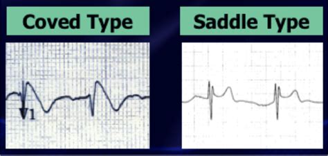 Brugada Syndrome Ecg Weekly