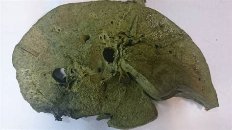 Gross Specimen Of The Liver With Psc Shows Green Color With Dilated Download Scientific Diagram