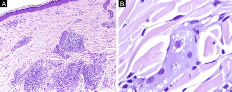 A Dermal Lymphoplasmacytic Infiltrate And Granulomatous Infiltrate