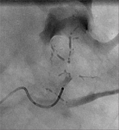 Optimal Ethanol Ethiodol Emulsion Ratio In Renal Angiomyolipoma
