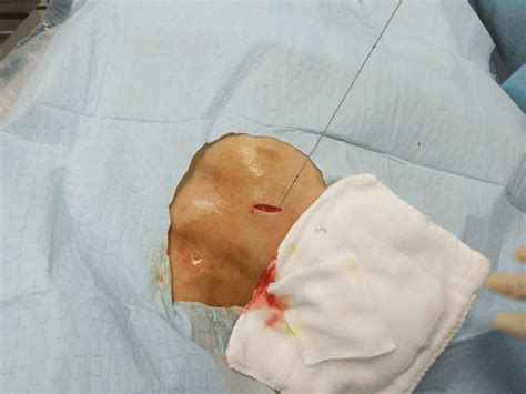 Is Venous Port Implantation Should Be Guided By X Ray ResearchGate