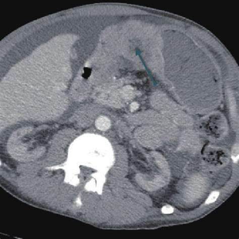 Egd Shows An Ulcerated Mass In The Stomach Antrum With Partial Gastric
