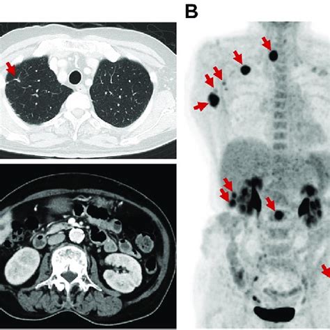 Tumor Responses To One Cycle Of Atezolizumab Plus Chemotherapy A
