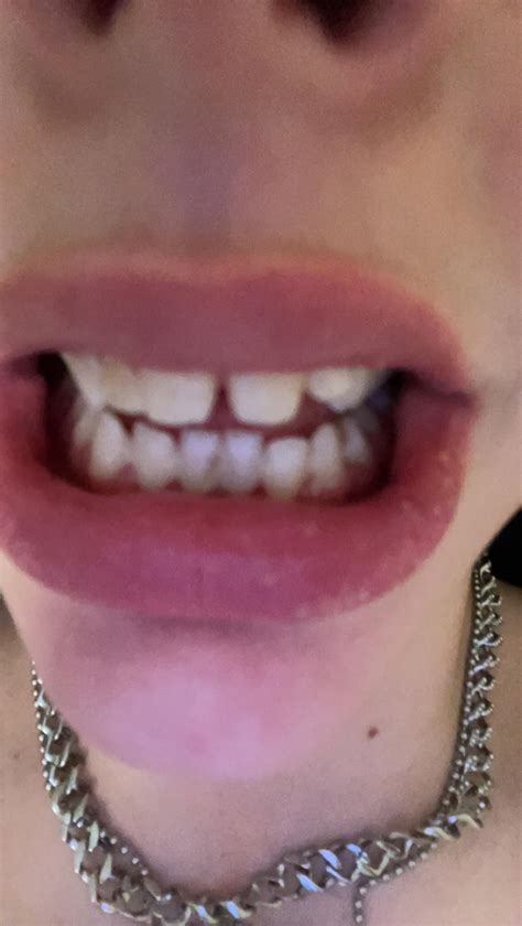 What Type Of Bite Is This Over Bite Open Bite Over Jet Asking For A Friend R Teethcare