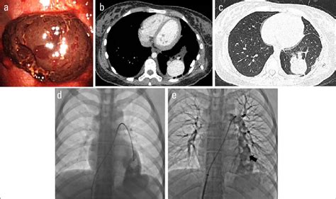 A Thoracoscopic View Showing A Large Mass In The Left Lower Lobe B Download Scientific