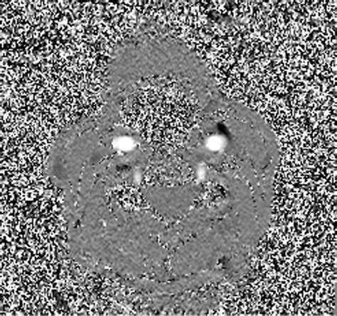 Mri Velocity Encoding Venc Mri
