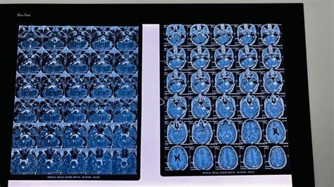 Dr Margi Pandya On Linkedin Ionm Dns Neuromonitoring Cpangletumour