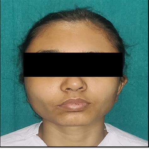 Clinical Photograph Showing Unilateral Swelling Over The Right Side Of