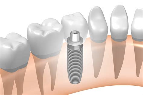 How Long Do Dental Implants Last