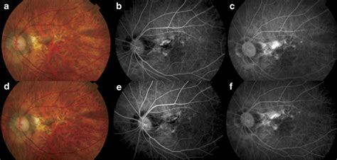 Fundus Photo Of The Left Eye Of A 64 Year Old Woman With Subfoveal
