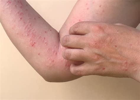 ชวนเช็ก โรคแพ้ภูมิตัวเอง Sle เอาชนะได้ไหม ทำไมต้องแพ้