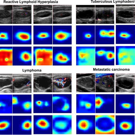 Examples Of Heatmaps Generated By Cla Hdm For Each Etiology Of