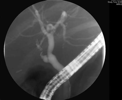 Two Months Post Cholecystectomy Ercp Showing Complete Resolution Of
