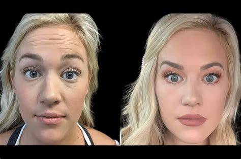 Hifu Vs Botox Which Is Better For You In Islamabad