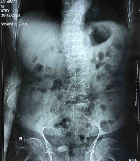 Vesical Calculus In Morbid Patient