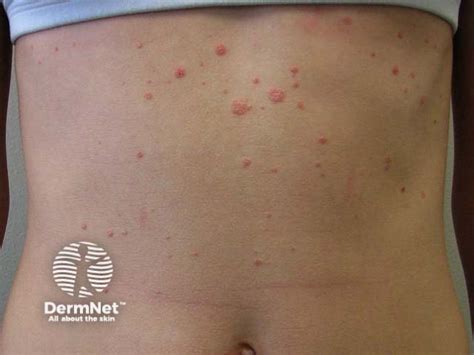 Guttate Psoriasis