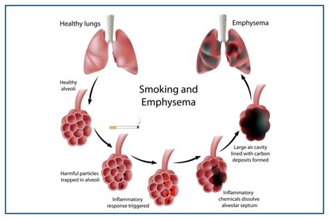 What Is Emphysema Symptoms Causes And Diagnosis Symptoms Tips Page My