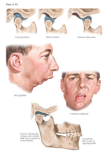 Abnormalities Of Temporomandibular Joint The Glenoid Fossa Of The