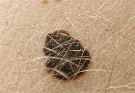 نصائح للوقاية من سرطان الجلد